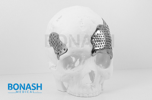 Cranial Custom Made Implant - Bonash Medical - Patient Specific Implants