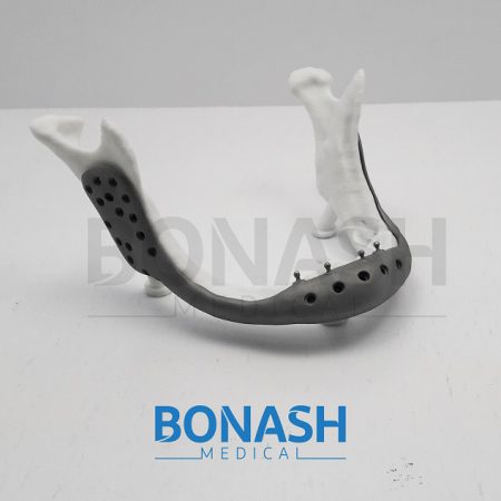 Maxillary & mandibular defects - Bonash Medical - Patient Specific Implants